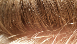5 Treatments for How to Get Rid of Head Lice - Kiwi Families